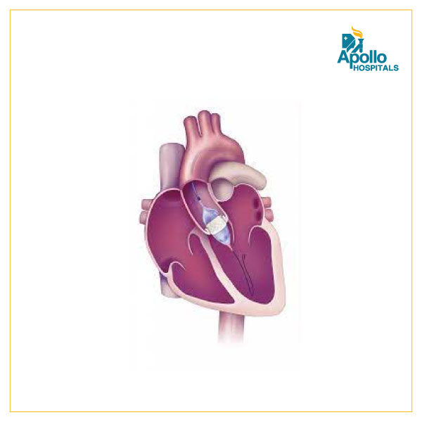 Advantages of TAVI | Apollo Hospitals